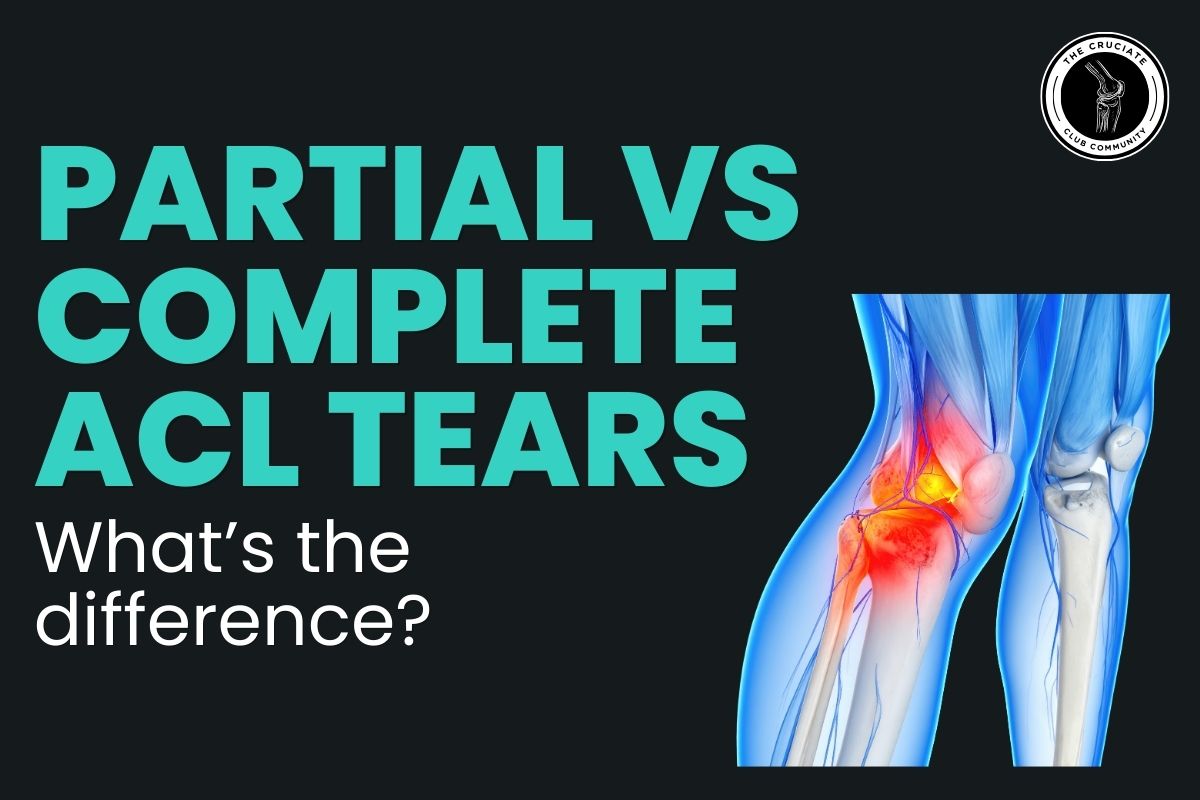 Partial vs Complete ACL Tear: What's the Difference? – AG Injury ...